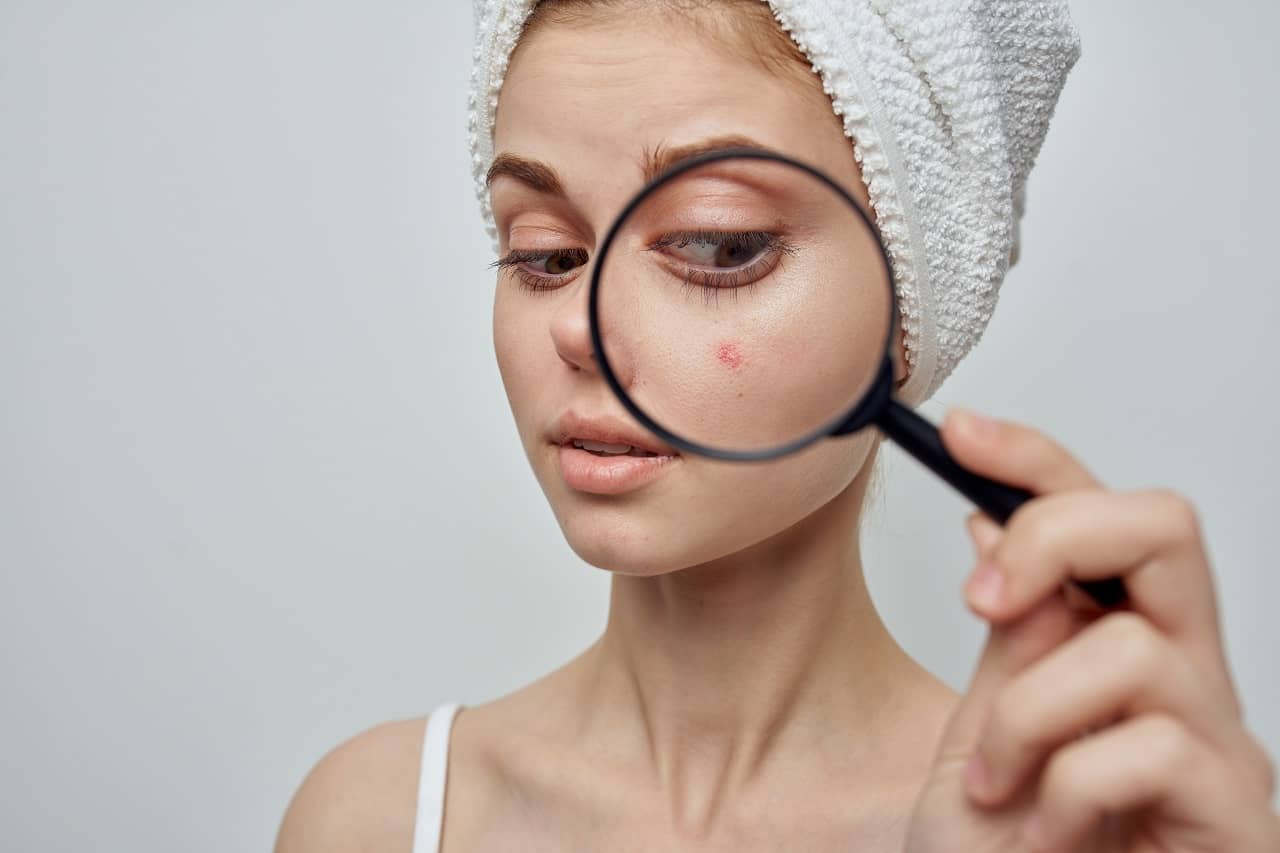 What Are The Main Causes Of Acne Kicker
